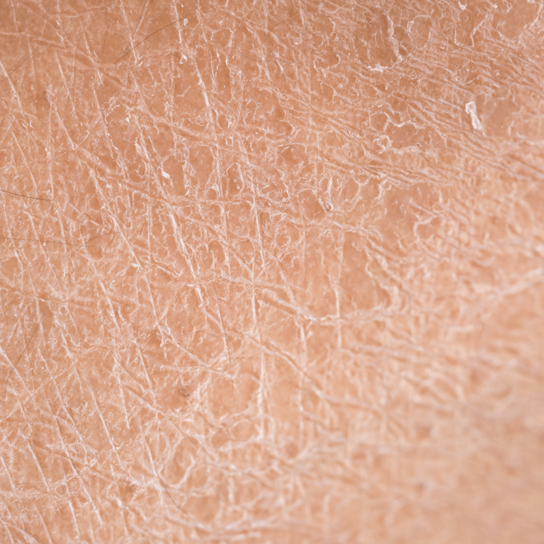 11 Surprising Reasons You Get Dry Skin - The Art of Anti-Aging